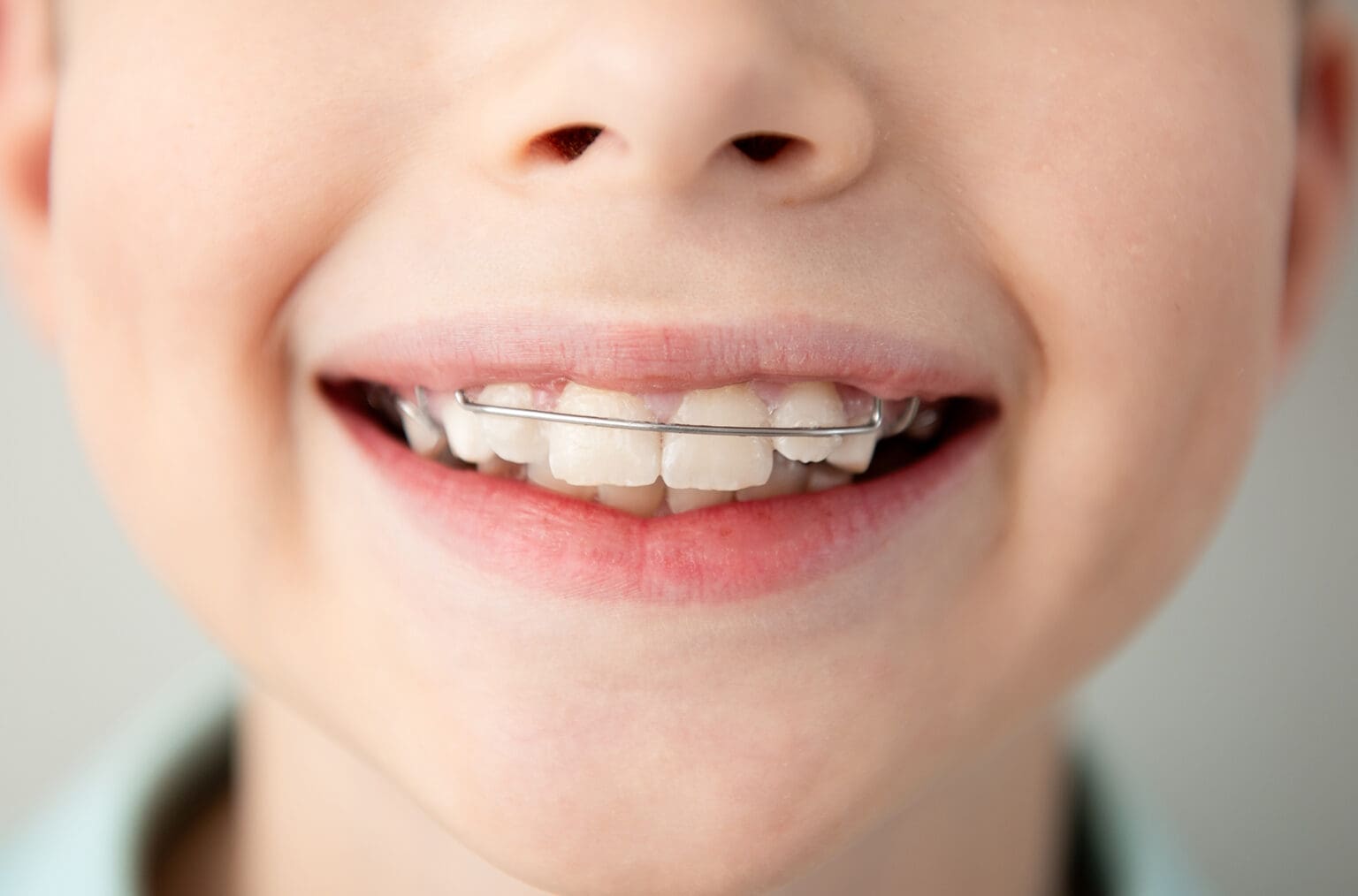 Do I Have To Wear Retainers Forever | Denver Youth Dentistry