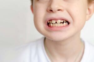 Enamel hypoplasia causes | Youth Dentistry and Orthodontics