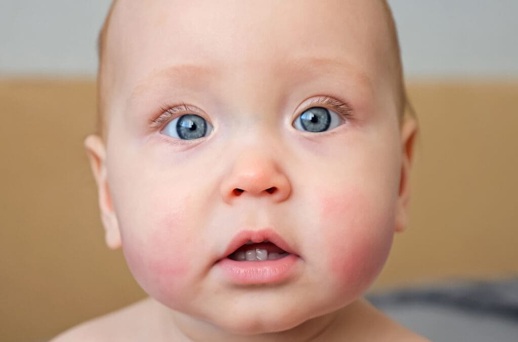 Red Cheeks from Teething | Dentist in Denver
