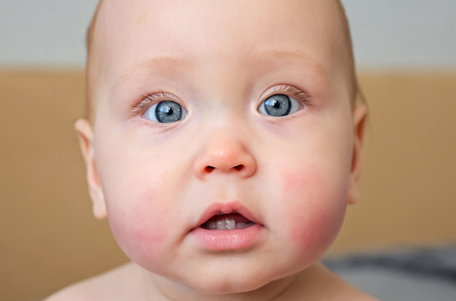 Red Cheeks from Teething | Dentist in Denver